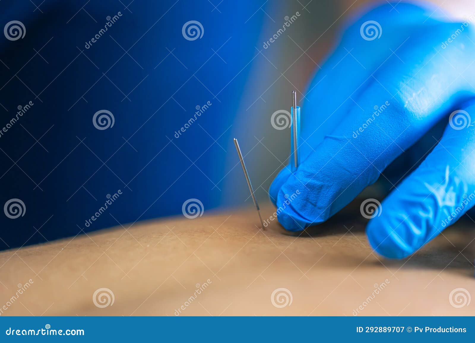 Close Up of a Needle and Hands of Physiotherapist Doing a Dry Needling ...