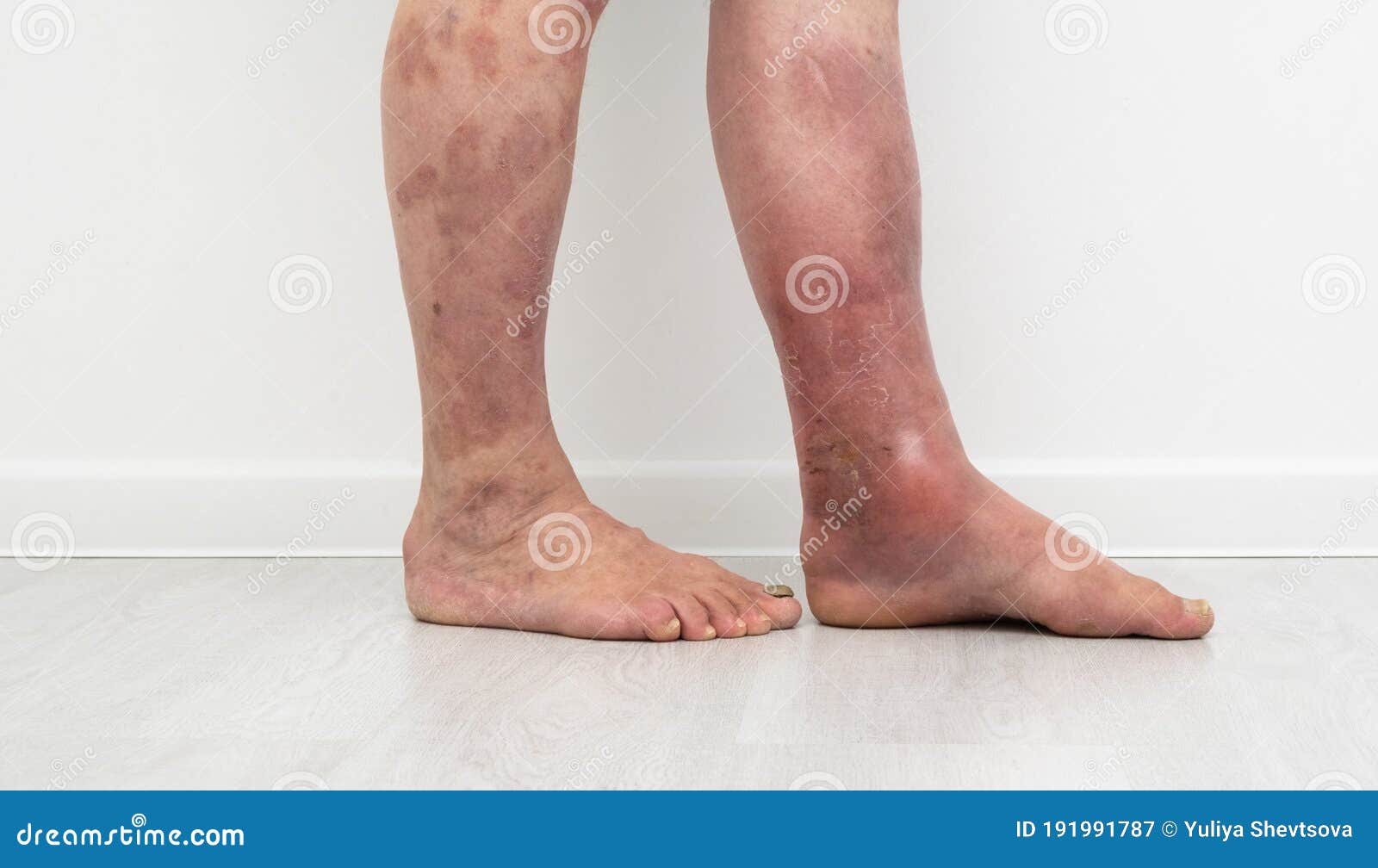 Close Up Photo of Legs with Lymphostasis and Psoriasis. Stock Image ...