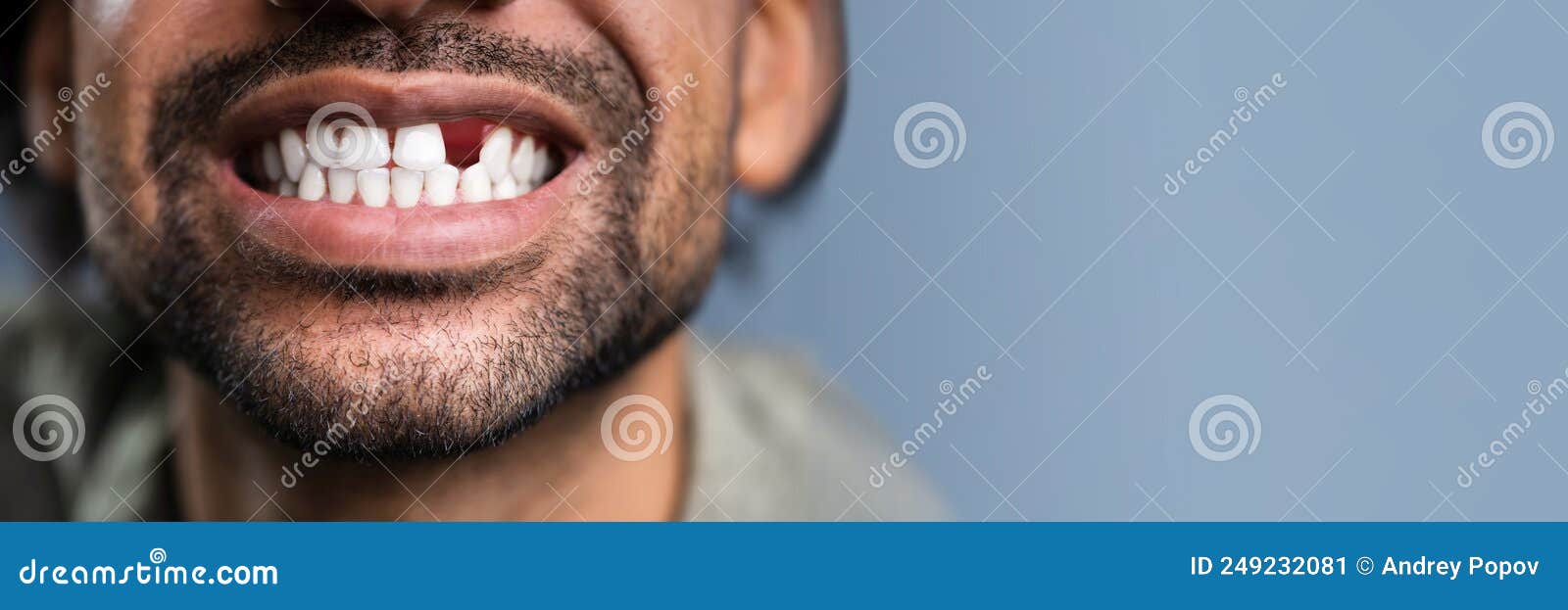 Photo of Young Man with Missing Tooth Stock Image - Image of closeup ...