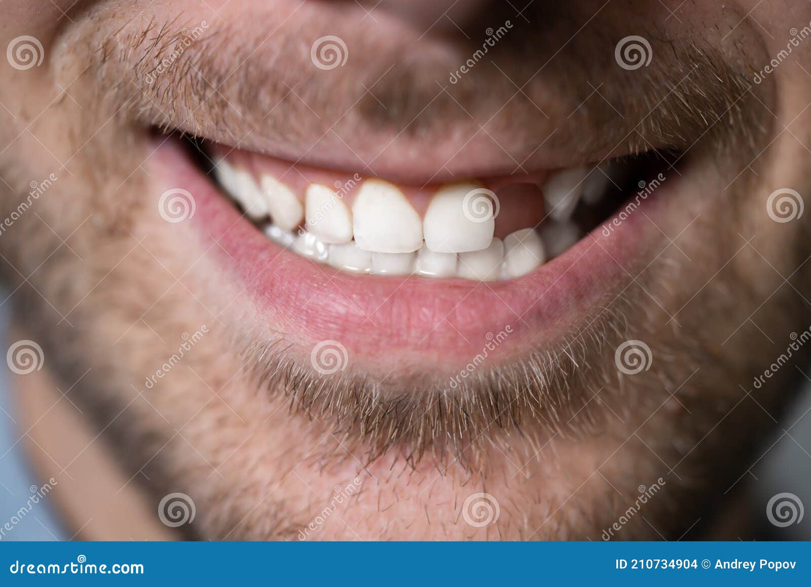 Man with Missing Tooth stock photo. Image of broken - 210734904