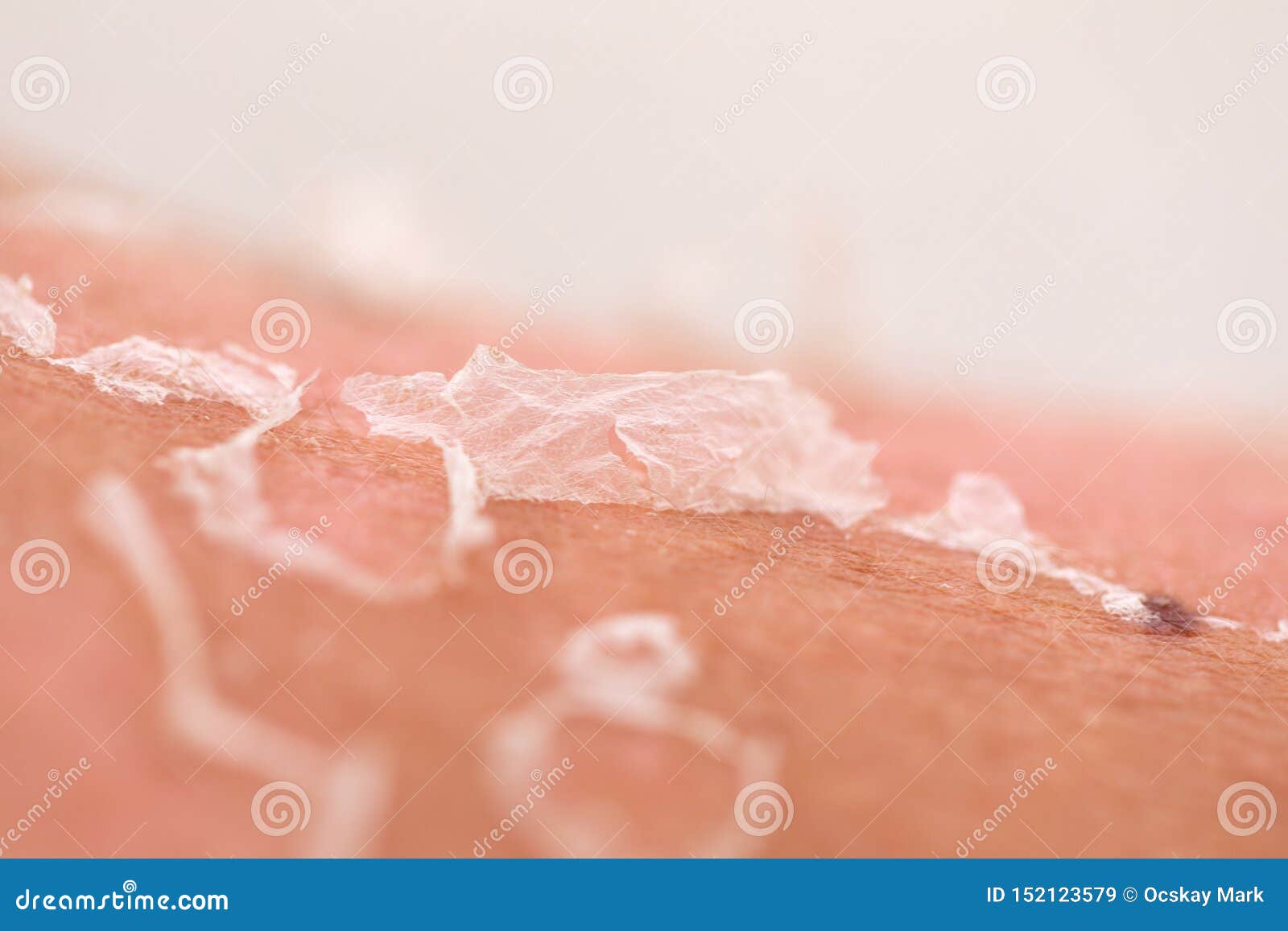 Skin Peeling After Sunburn Stock Image Image Of Danger 152123579
