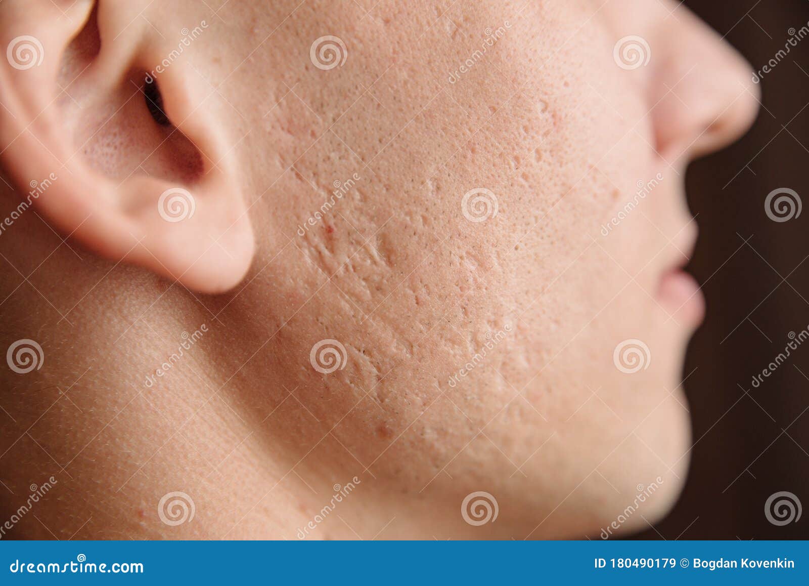 Acne scars on the face stock image. Image of health - 180490179