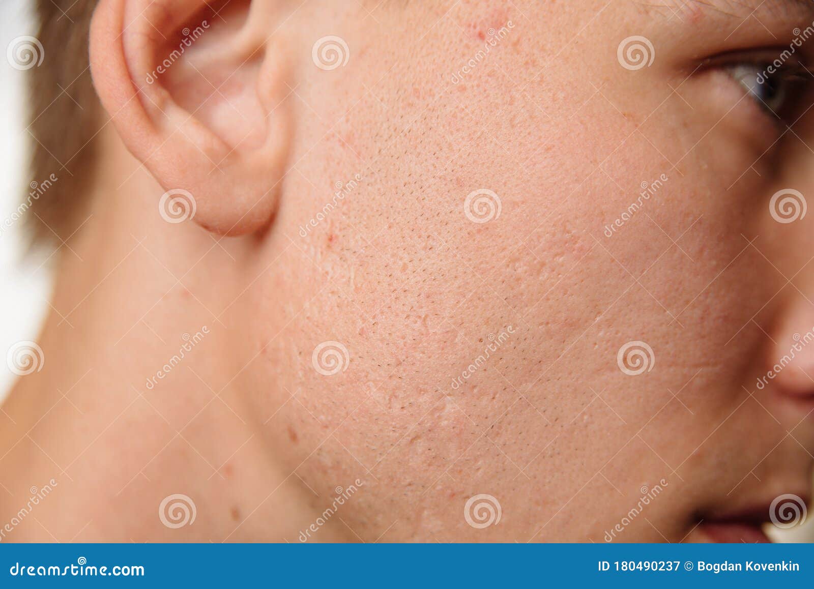 Acne scars on the face stock image. Image of problems - 180490237