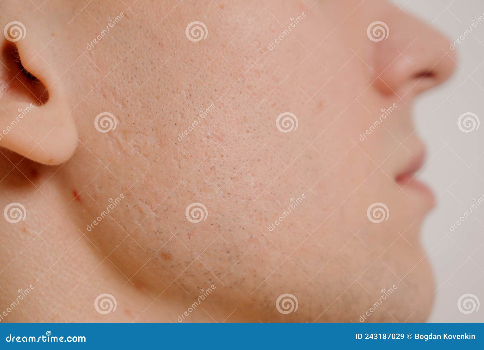 Acne scars on the face stock image. Image of hygiene - 243187029