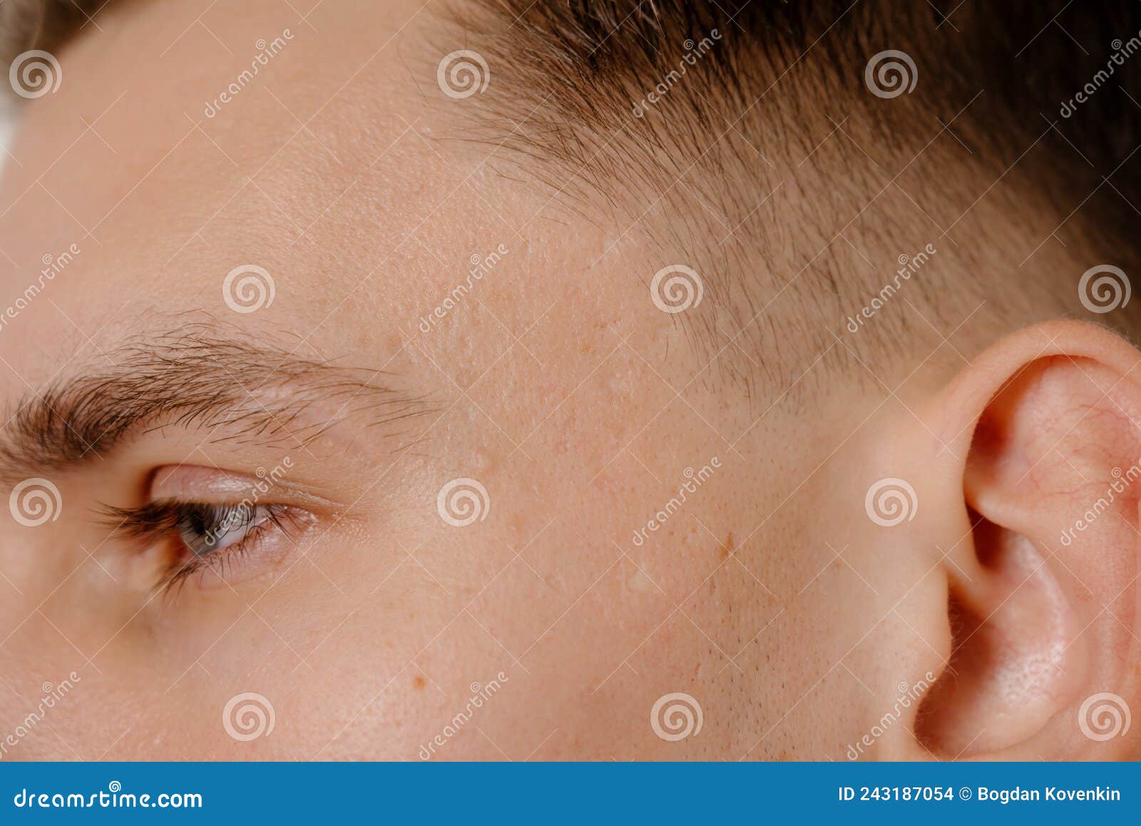 Acne scars on the face stock photo. Image of medicine - 243187054