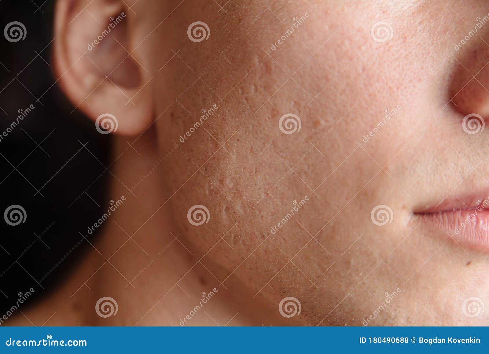 Acne scars on the face stock photo. Image of medicine - 180490688