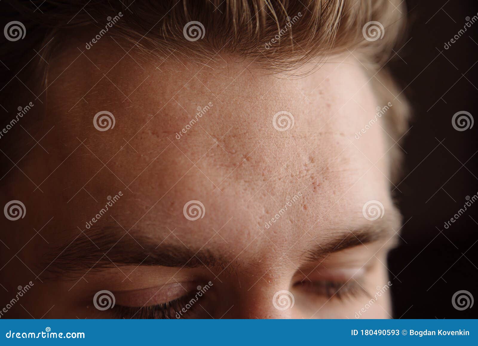 Acne scars on the face stock image. Image of medical - 180490593
