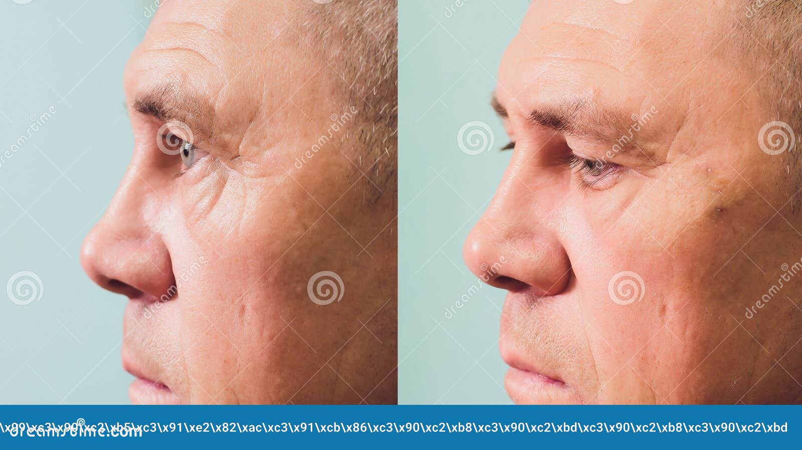 Close-up of Procedure for Face Lifting PDO Suture Operation, Face ...