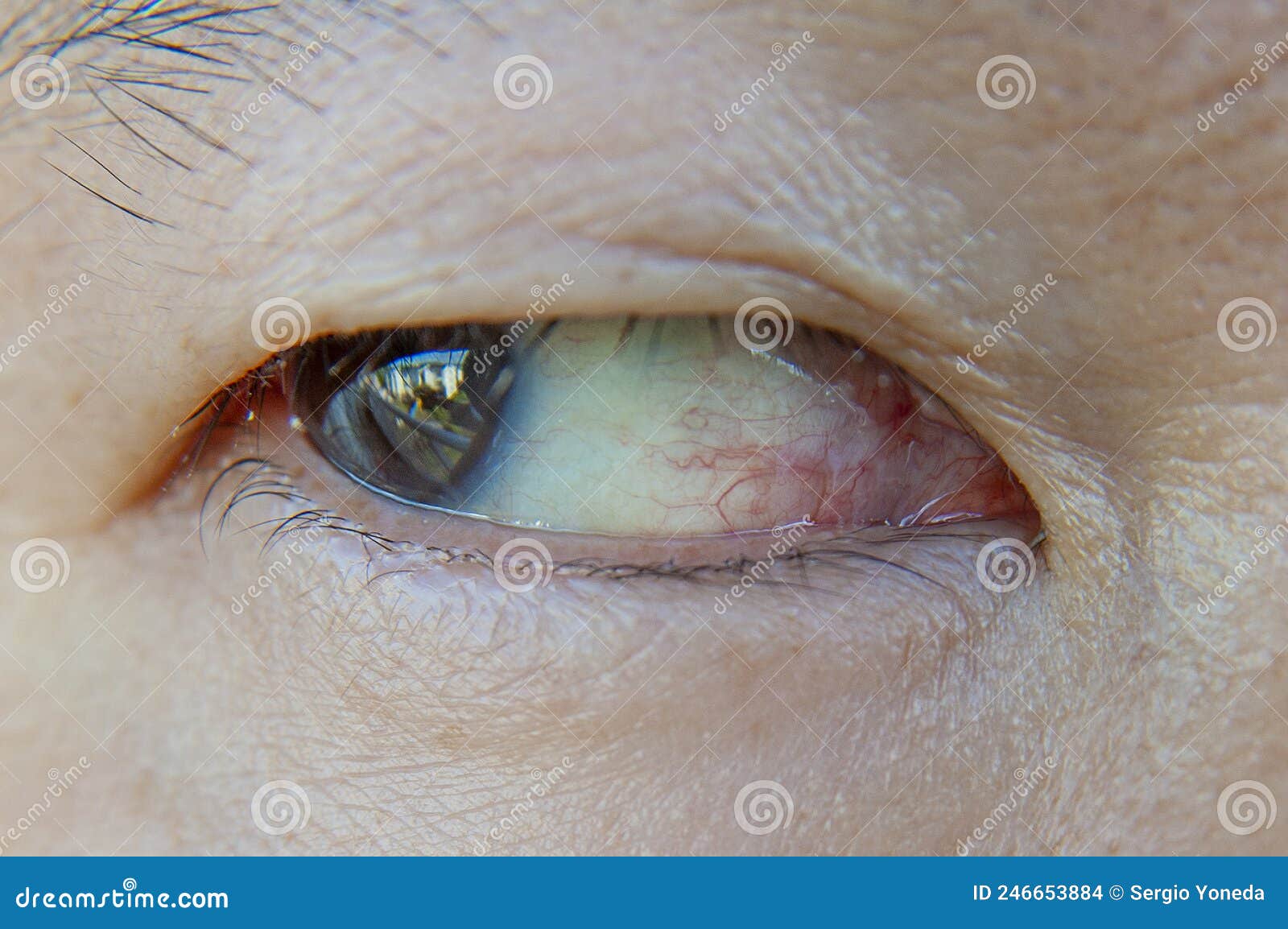 Subconjunctival Hemorrhage Or Subconjunctival Bleeding, Hyposhagmus ...