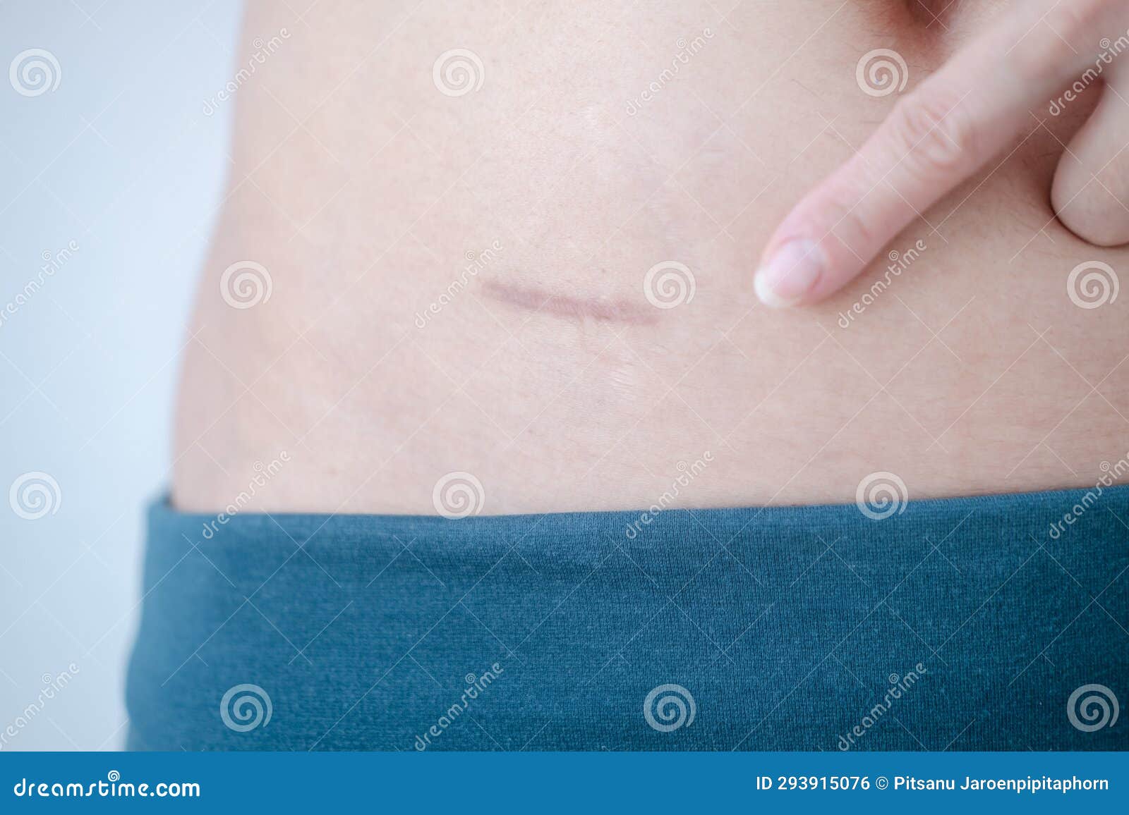 Scar Of Appendix Pain And Appendicitis Inflammation Disease Close Up ...