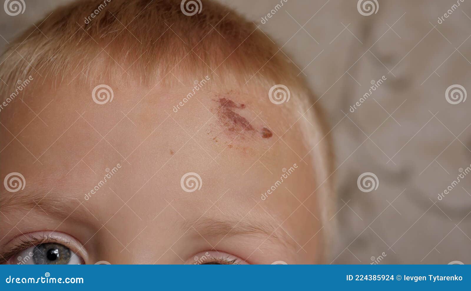 Close-up of a Scratch and a Bump on the Forehead of a Small Boy. Stock ...
