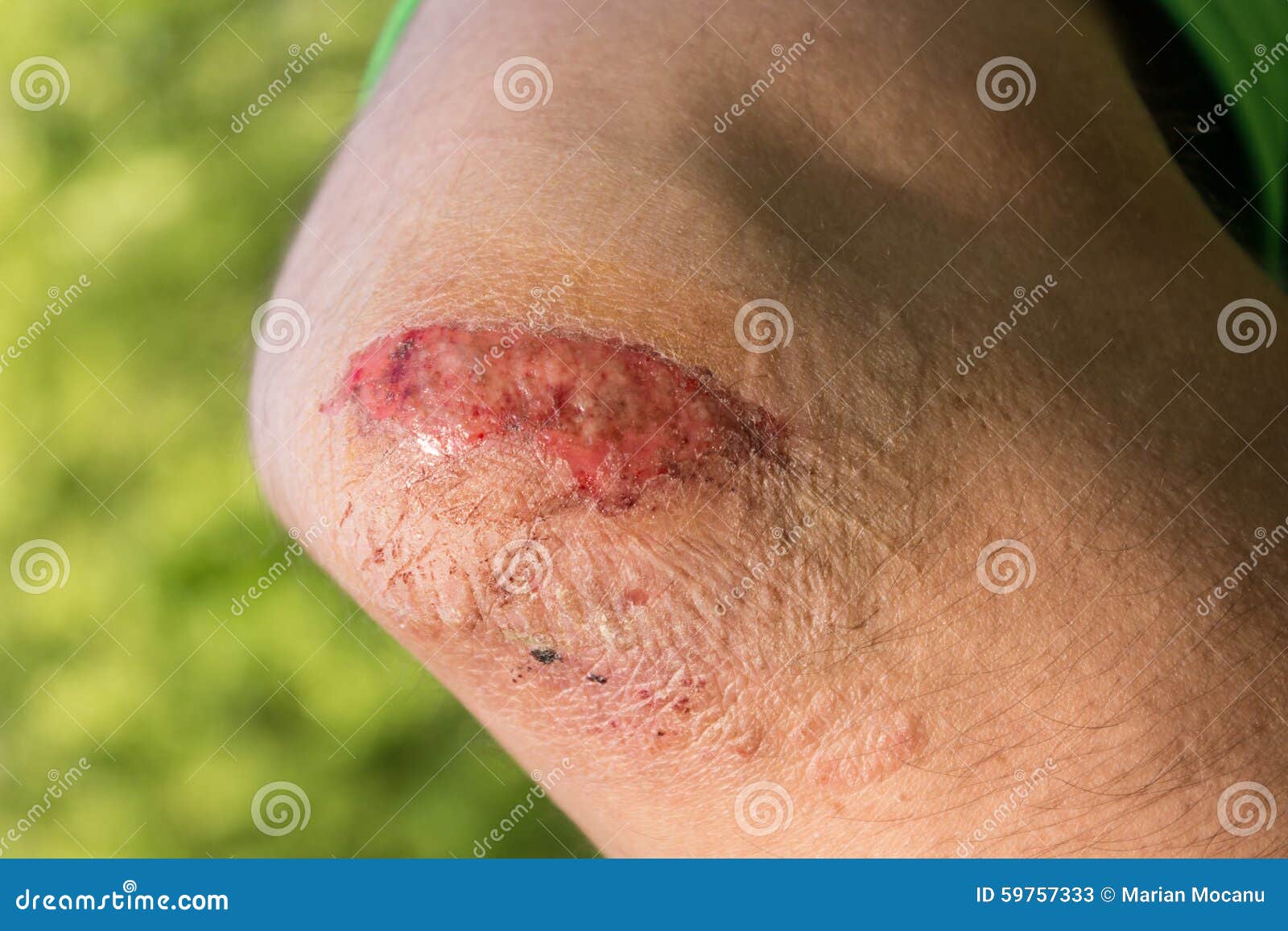 Close-up Of The Wound That Remained After Excision Of The Nevus ...
