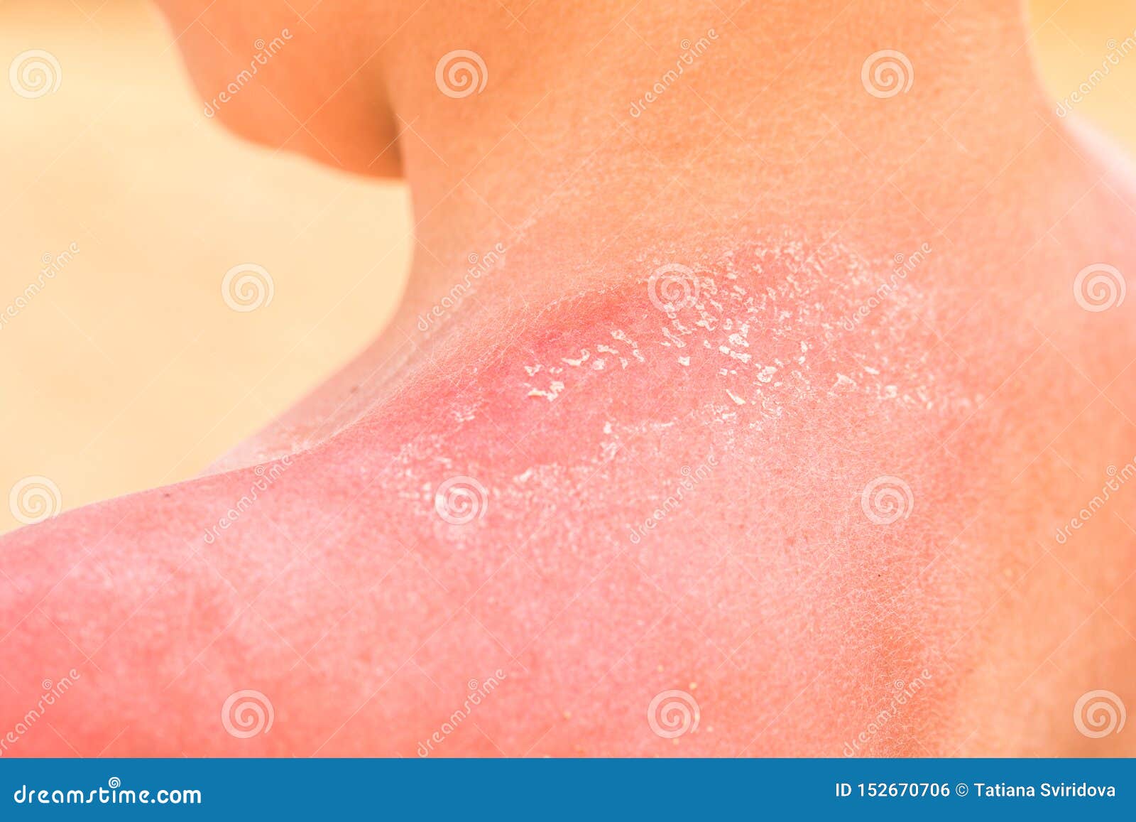 337 Burnt Scar Stock Photos - Free & Royalty-Free Stock Photos from ...