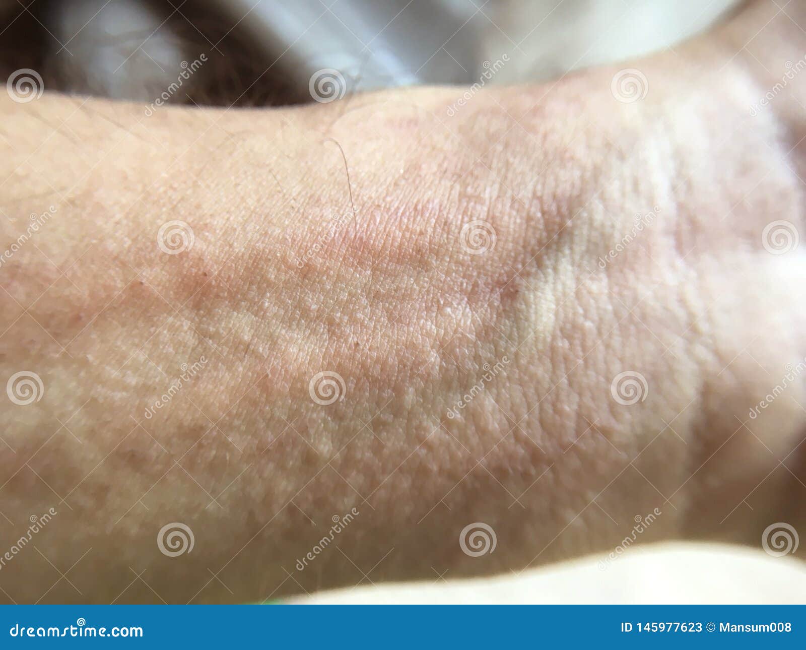 Skin rash on man hand stock image. Image of immune, rash - 145977623