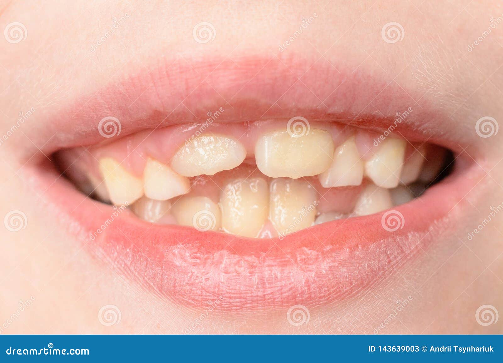 Close-up of a Small Boy with Curved Teeth Smiling Stock Image - Image ...
