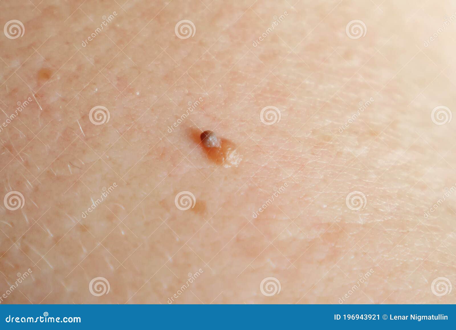 Small Mole Nevus On Human Skin, Carcinoma. Background, Macro Stock ...