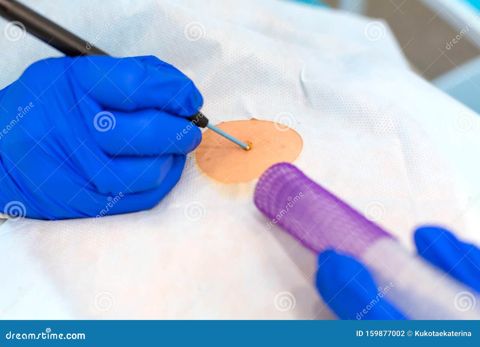 Close-up Surgeon Burns a Mole on the Back of the Patient. Mole Removal ...