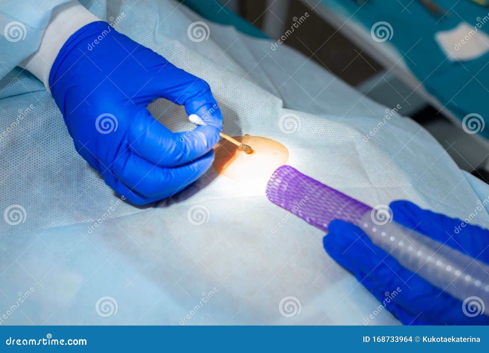 Close-up Surgeon Burns a Mole on the Back of the Patient. Mole Removal ...