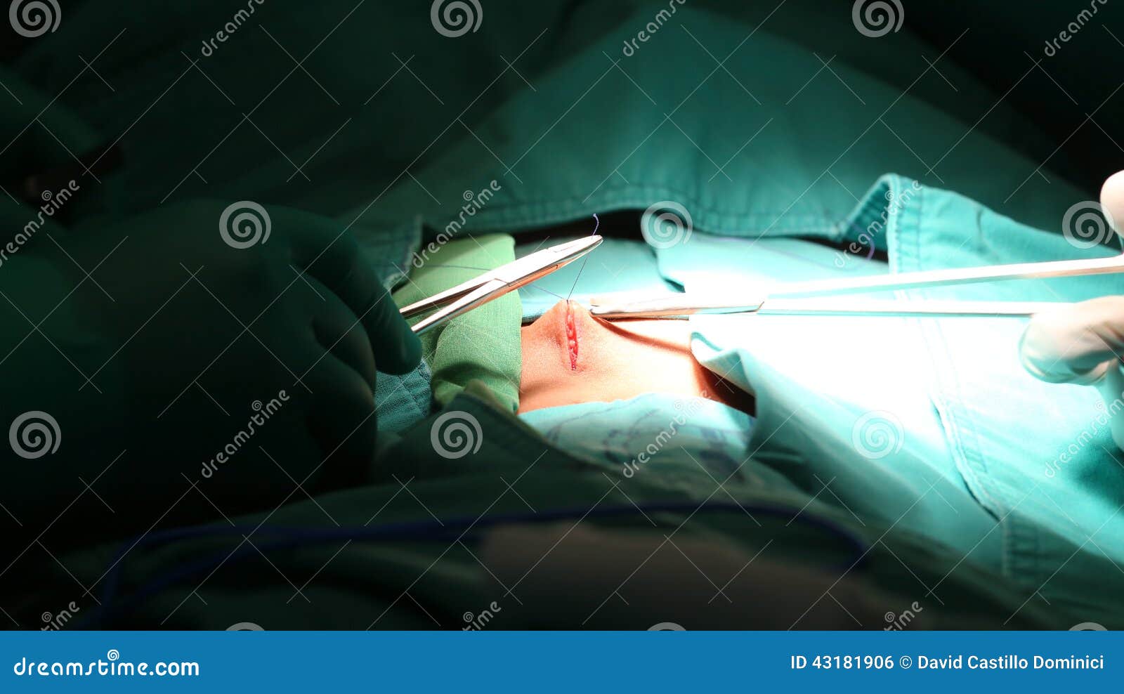 Close Up of a Suture in a Surgery Stock Photo - Image of suture ...