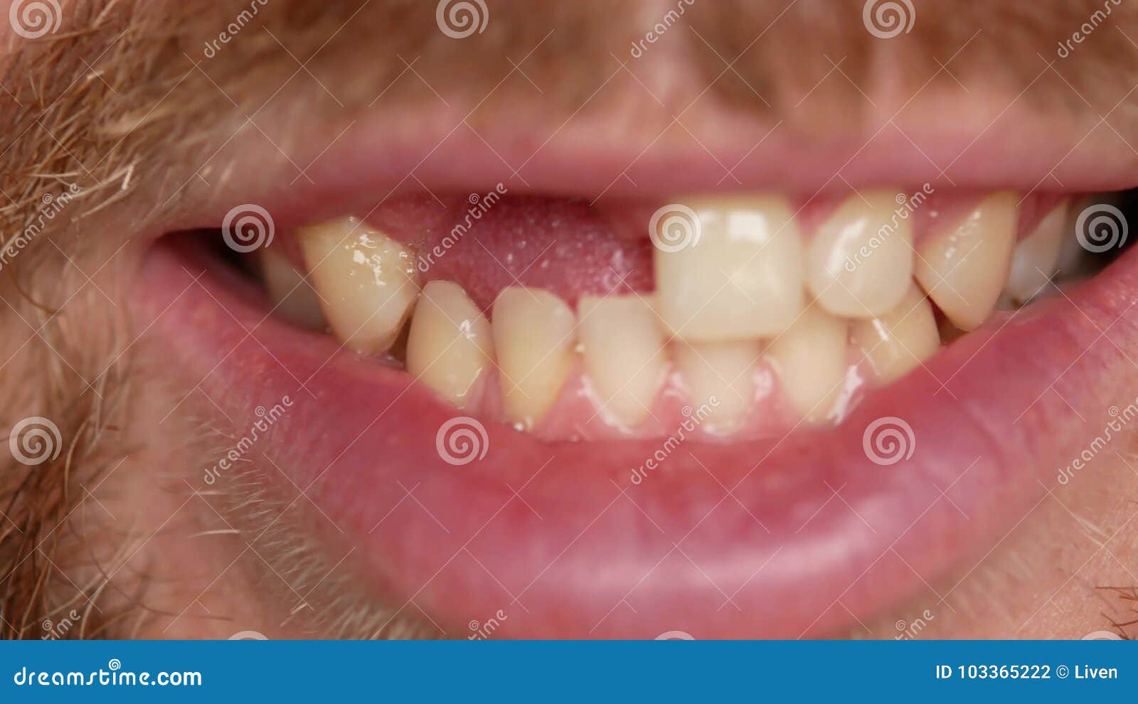 Close-up of Teeth. a Man Shows His Denture on Two Teeth Stock Footage ...