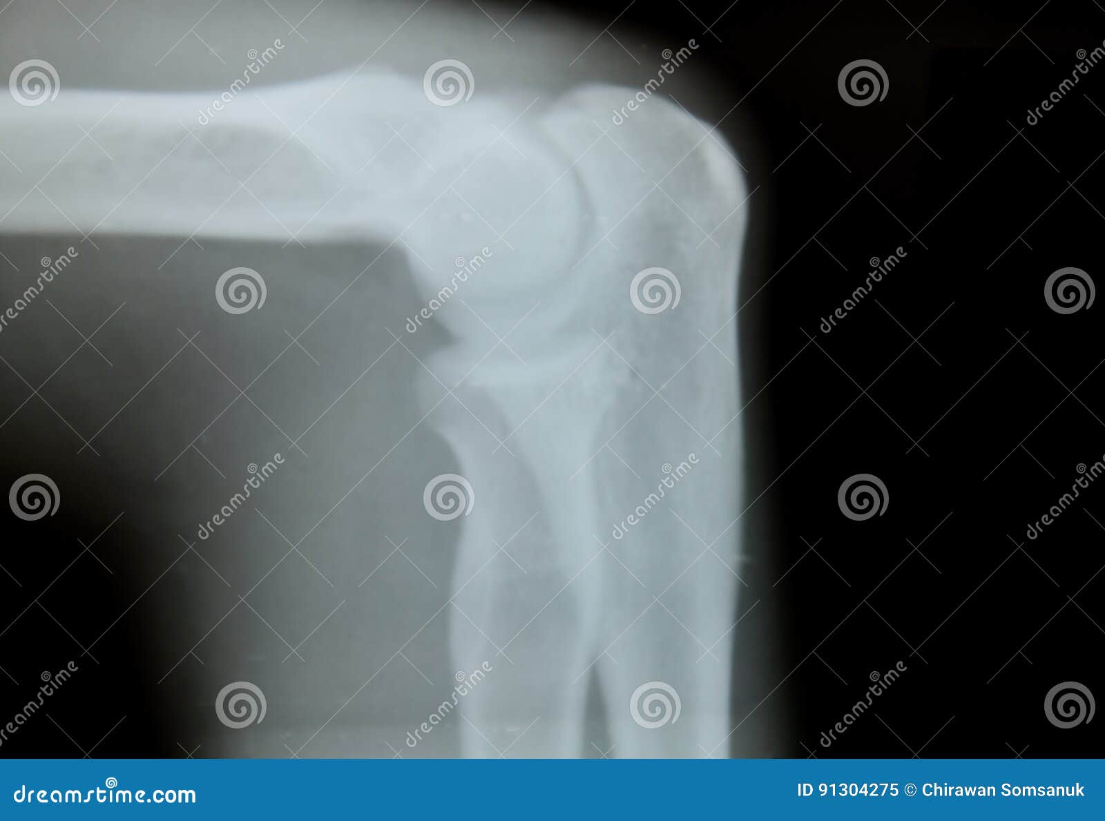 Close up Thigh bone stock image. Image of pelvis, scan - 91304275