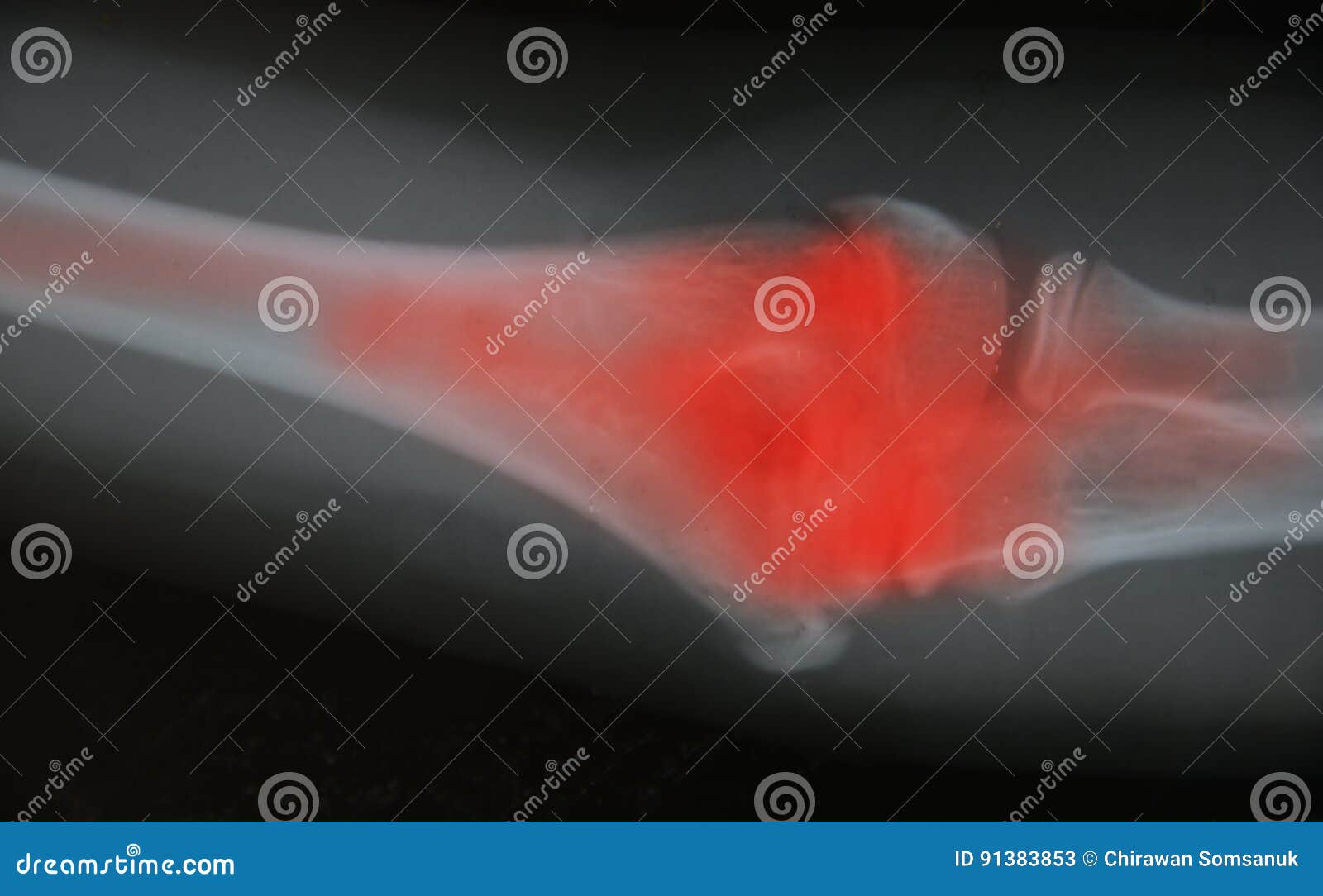 Close up Thigh bone stock image. Image of radiology, surgery - 91383853