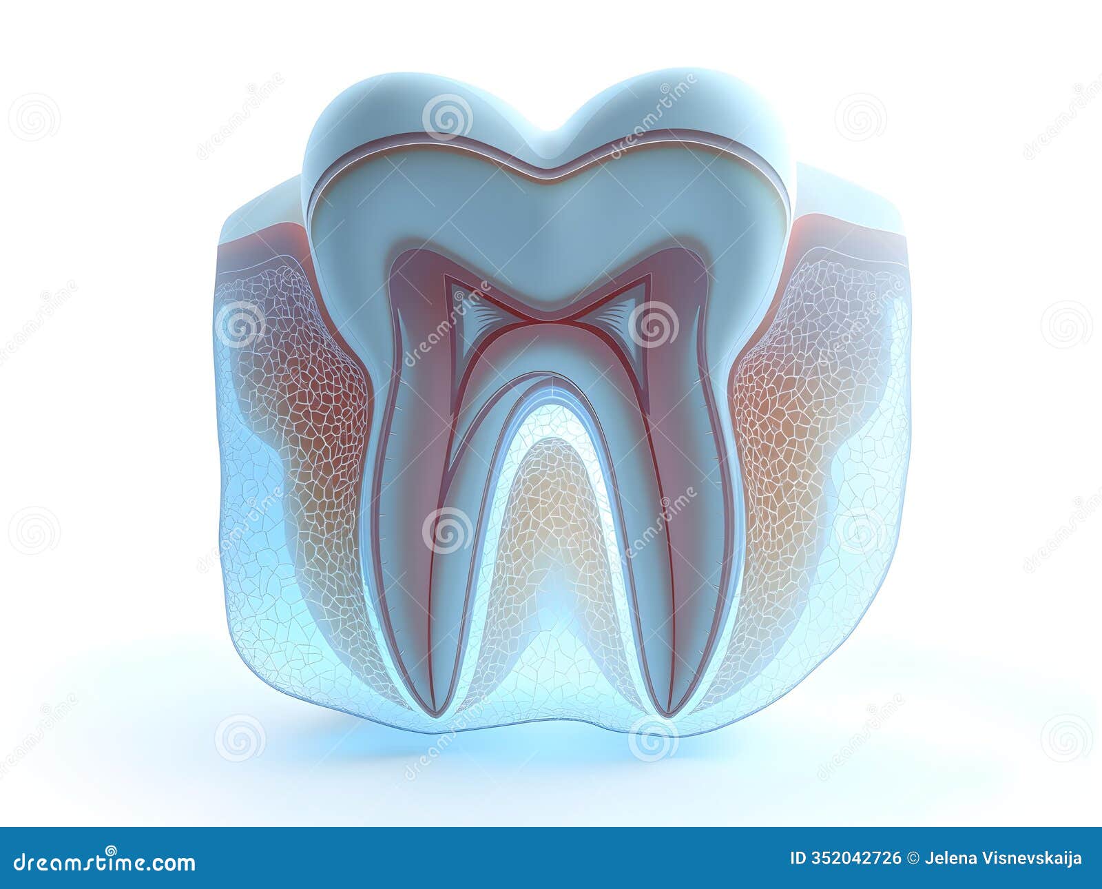 Tooth With Visible Plaque, Tartar And Calculus Royalty-Free ...