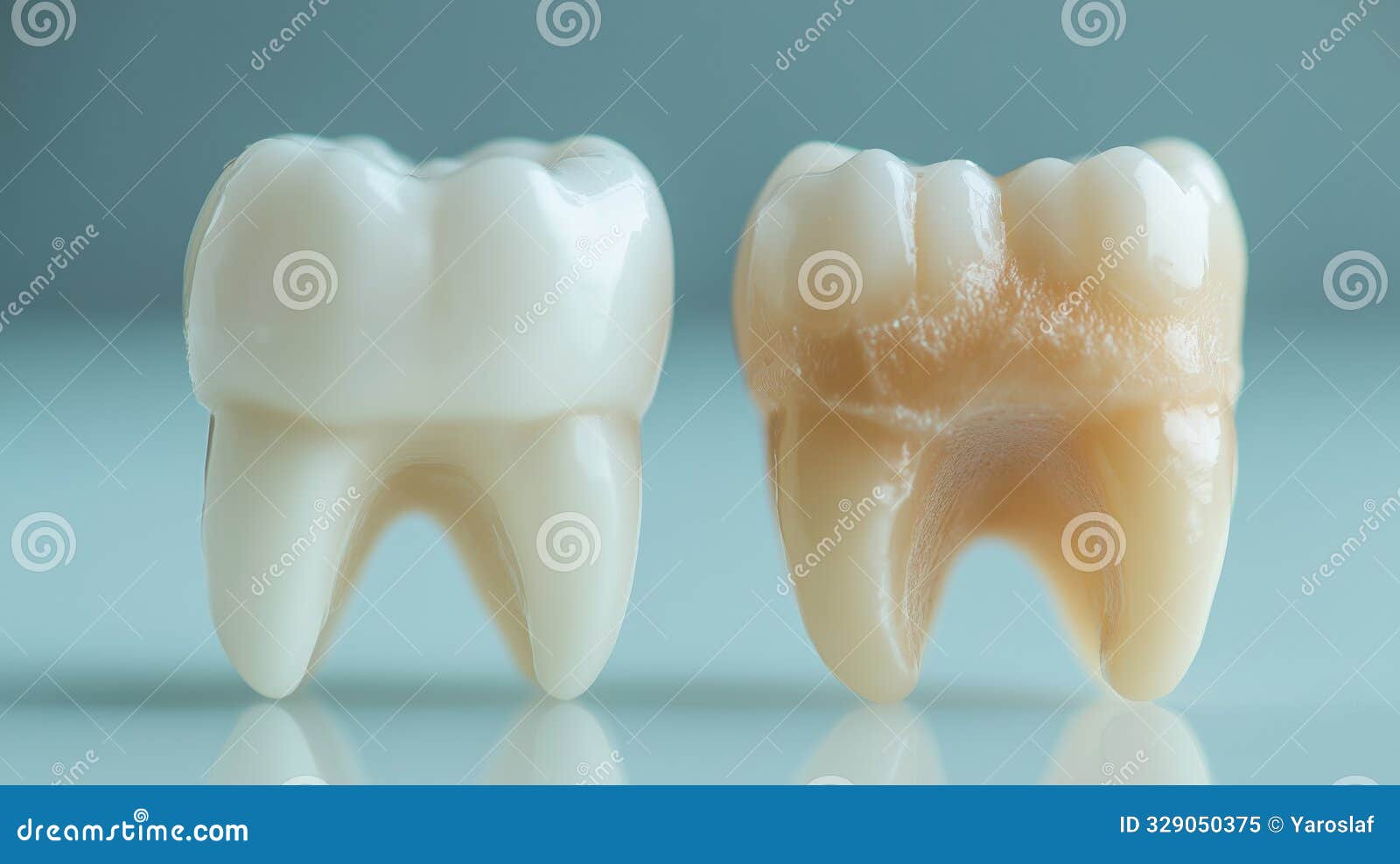 Close-up of Two Human Molar Teeth, One Healthy and One Decayed ...