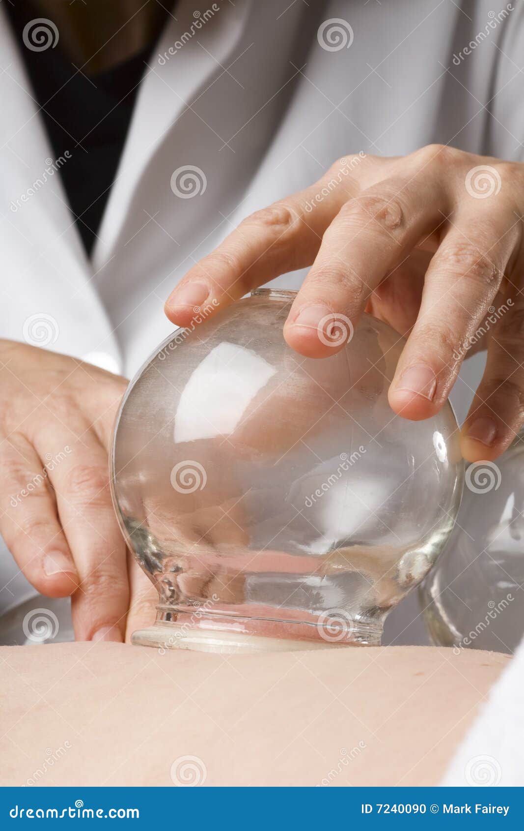Vacuum Cupping Therapy. Young Female Physiotherapist Using Glass ... Vacuum Cupping Therapy. Young Female Physiotherapist Using Glass ...