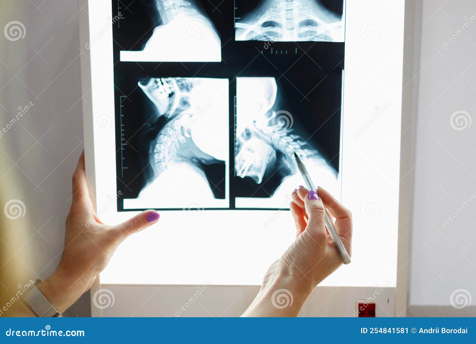 Close Up View of Doctor Hand with Pen Pointing at X-ray Image of Neck ...