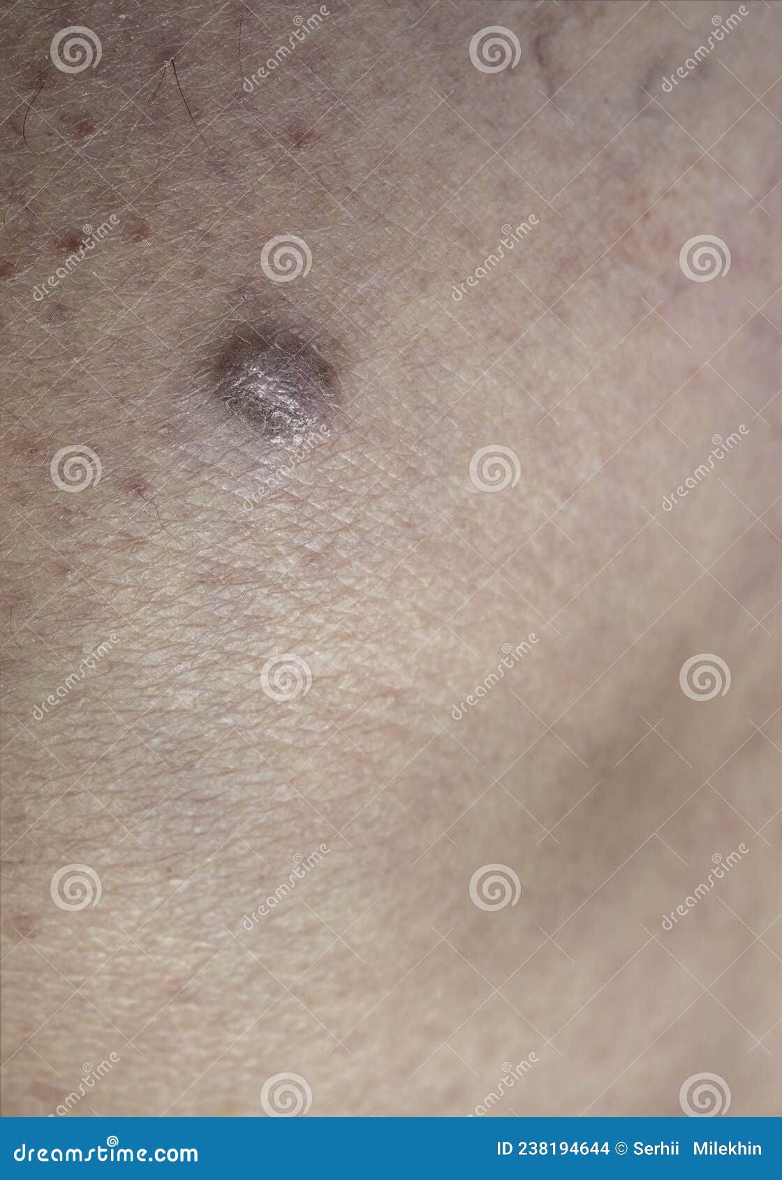 Close-up View of the an Human Skin with Human Skin Sarcoma. Stock Photo ...