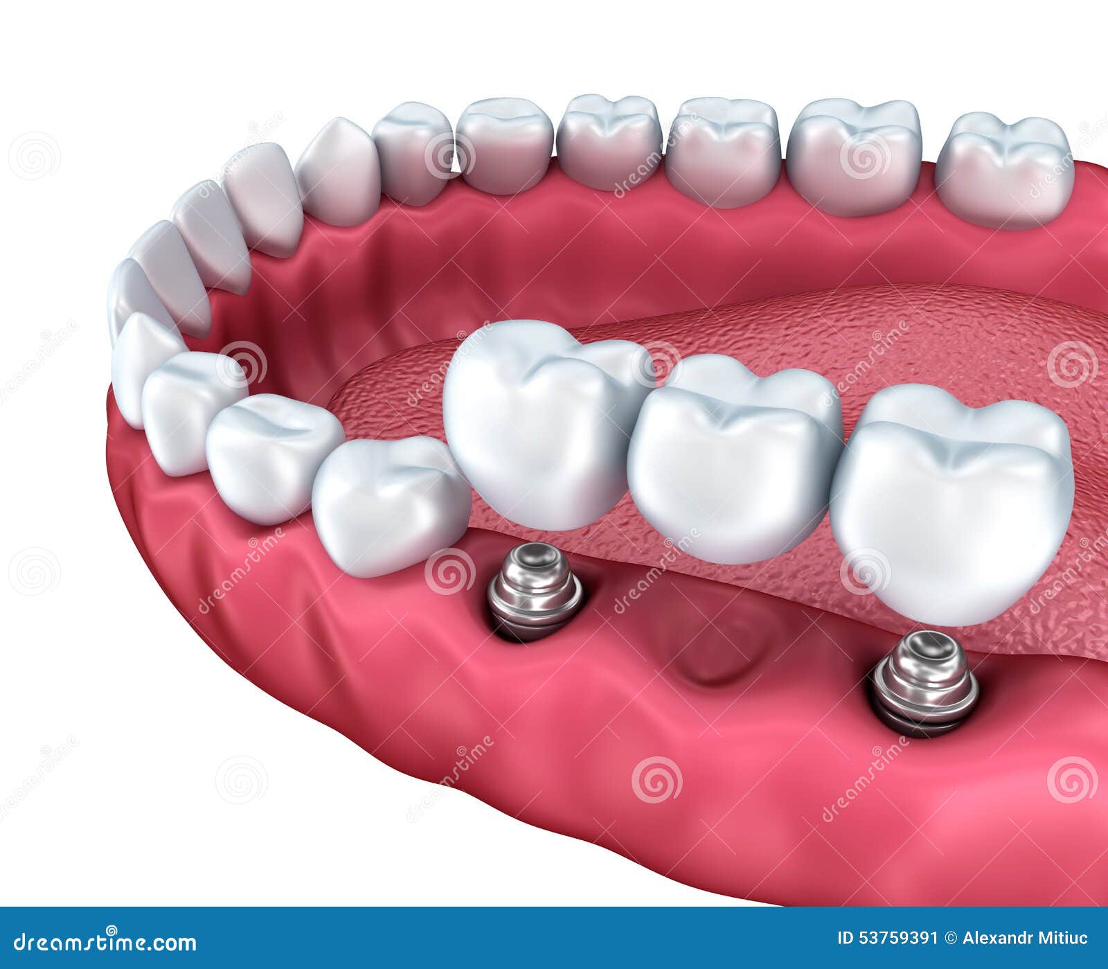 A Close-up View of Lower Teeth and Dental Implants Stock Illustration ...