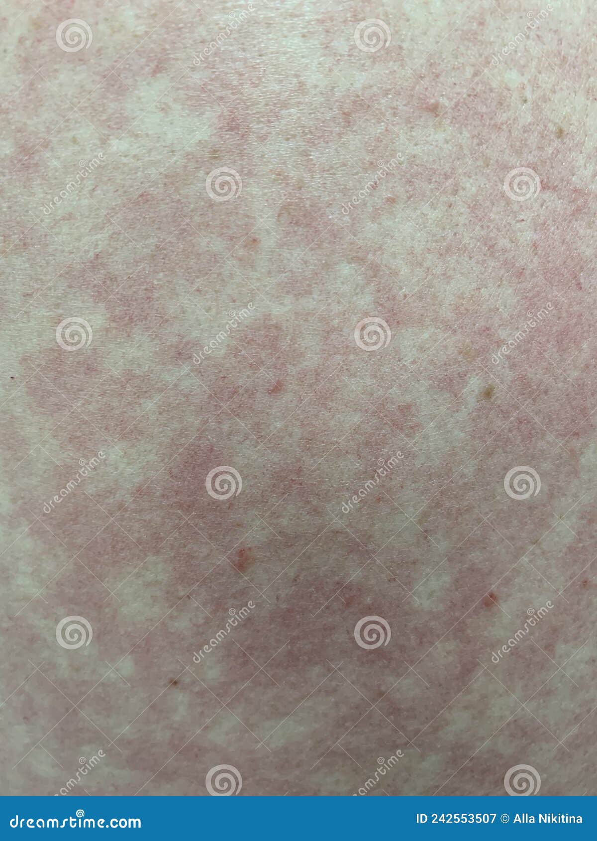 Close Up View of Man Back .Painful Back Skin Rash Stock Image - Image ...