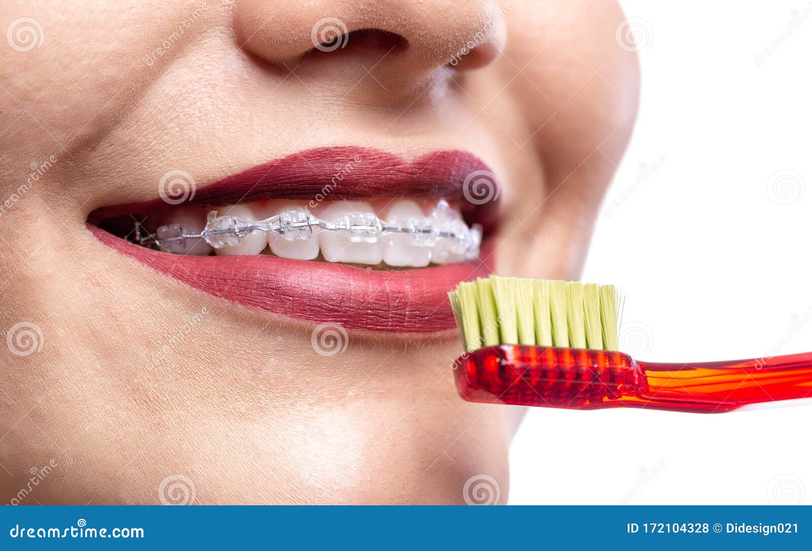 Close Up of White Teeth with Braces Stock Photo - Image of bristles ...
