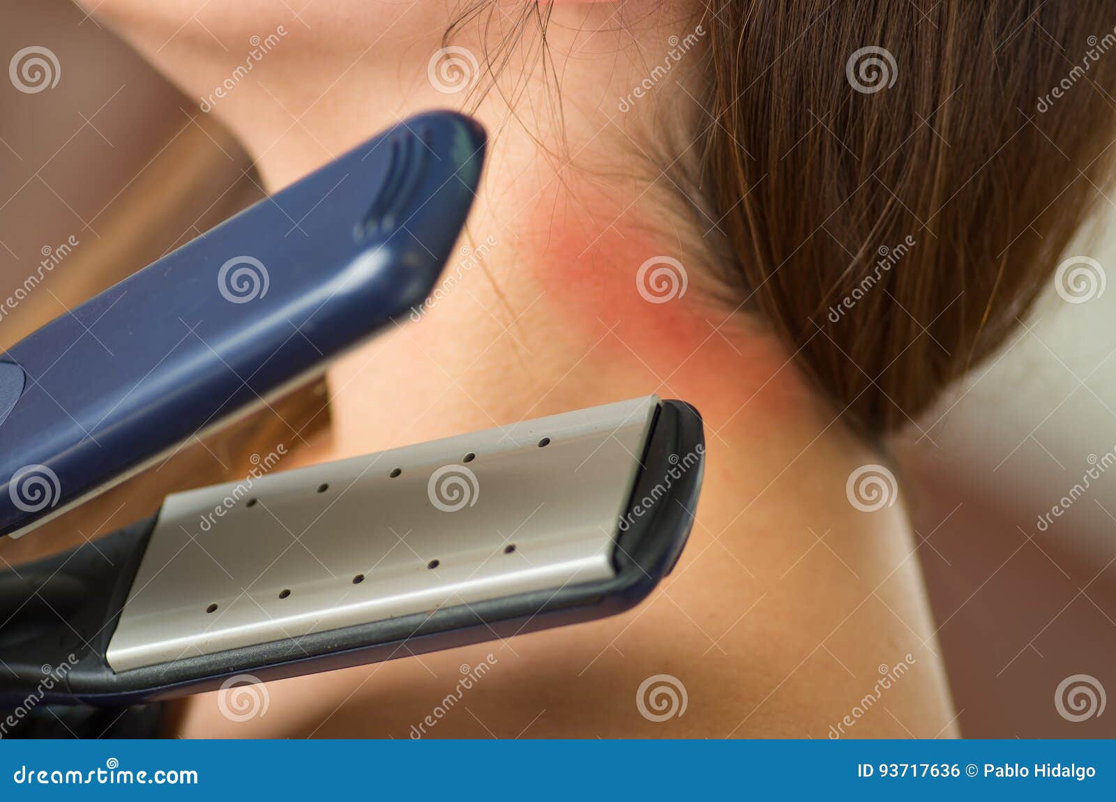 Close Up of a Woman Burned Her Shoulder Using Her Ironing Hair Stock ...