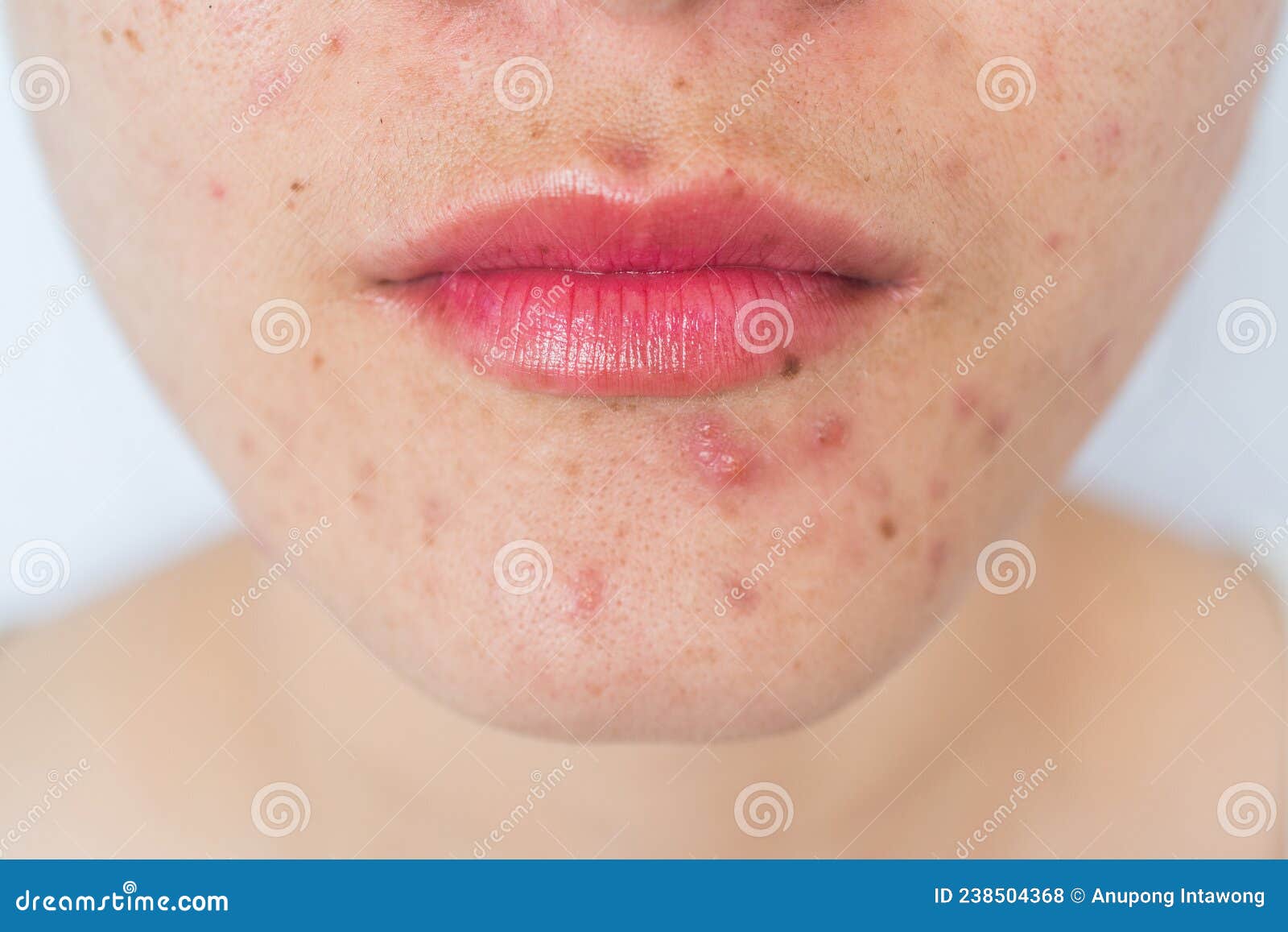Close Up of Woman Half Face with Problems of Acne Inflammation Papule ...
