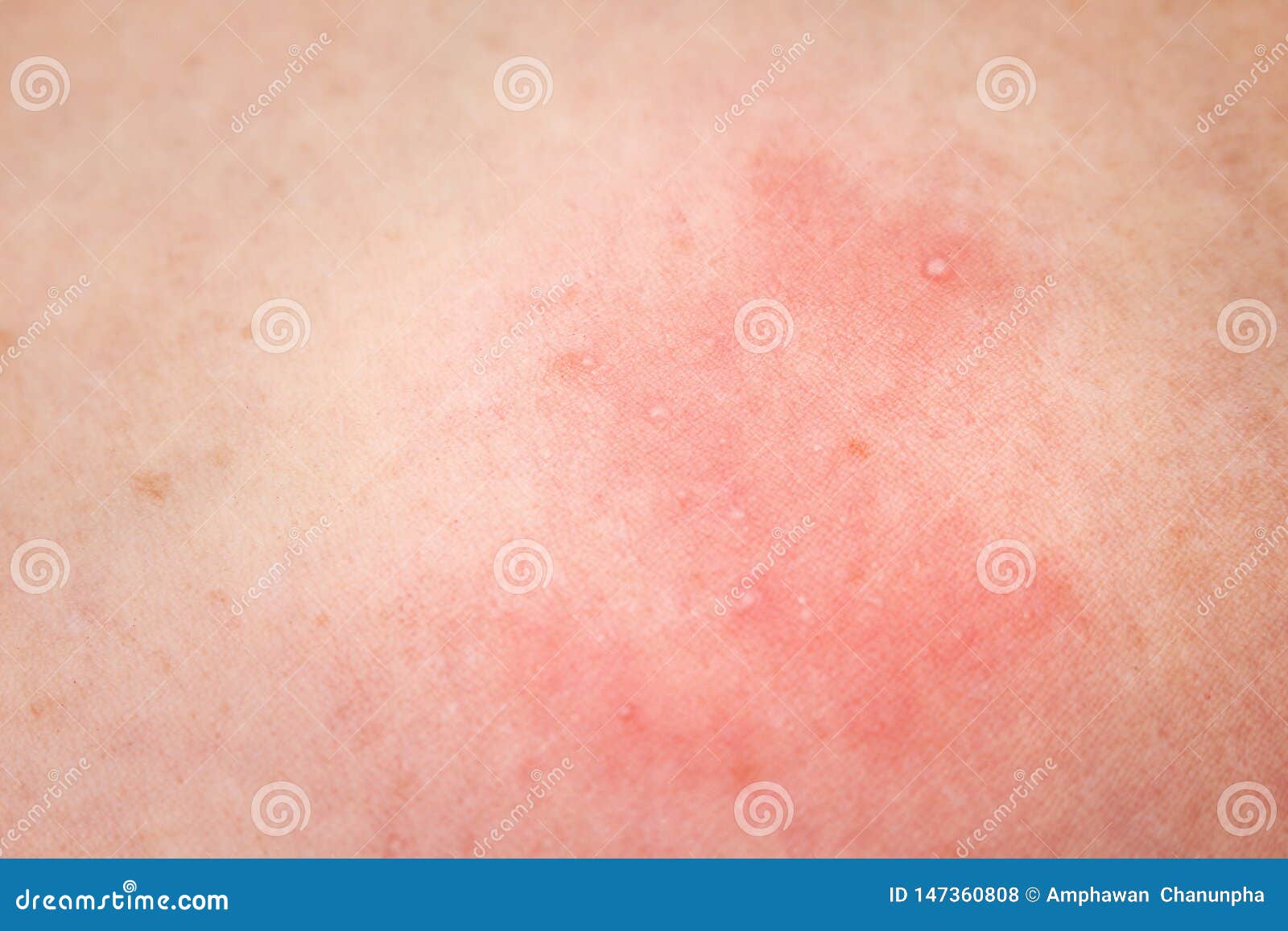 Woman has rash on her leg stock photo. Image of itchy - 147360808