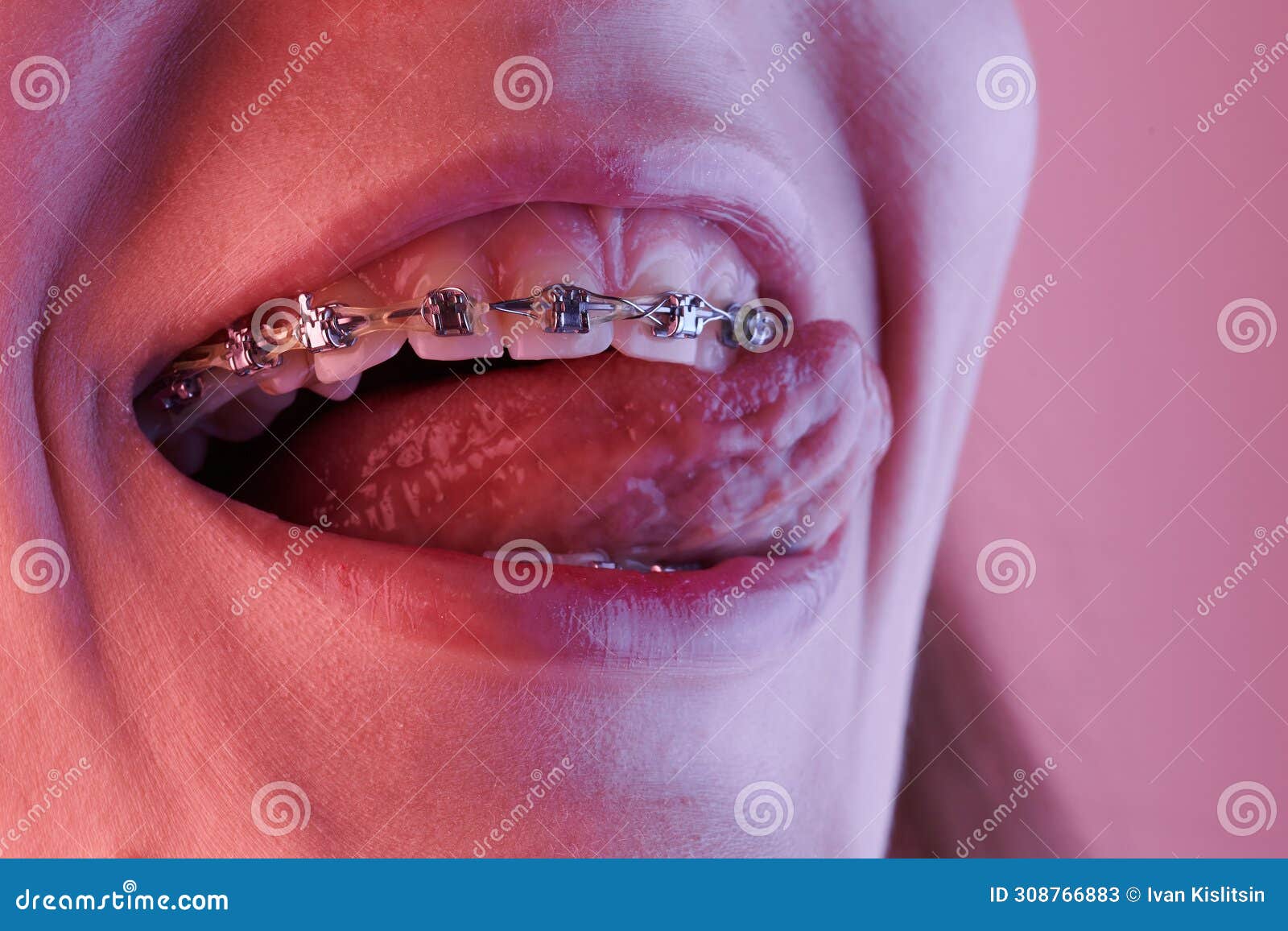 Close Up Of A Woman S Mouth With Braces On Teeth Stock Image Image Of