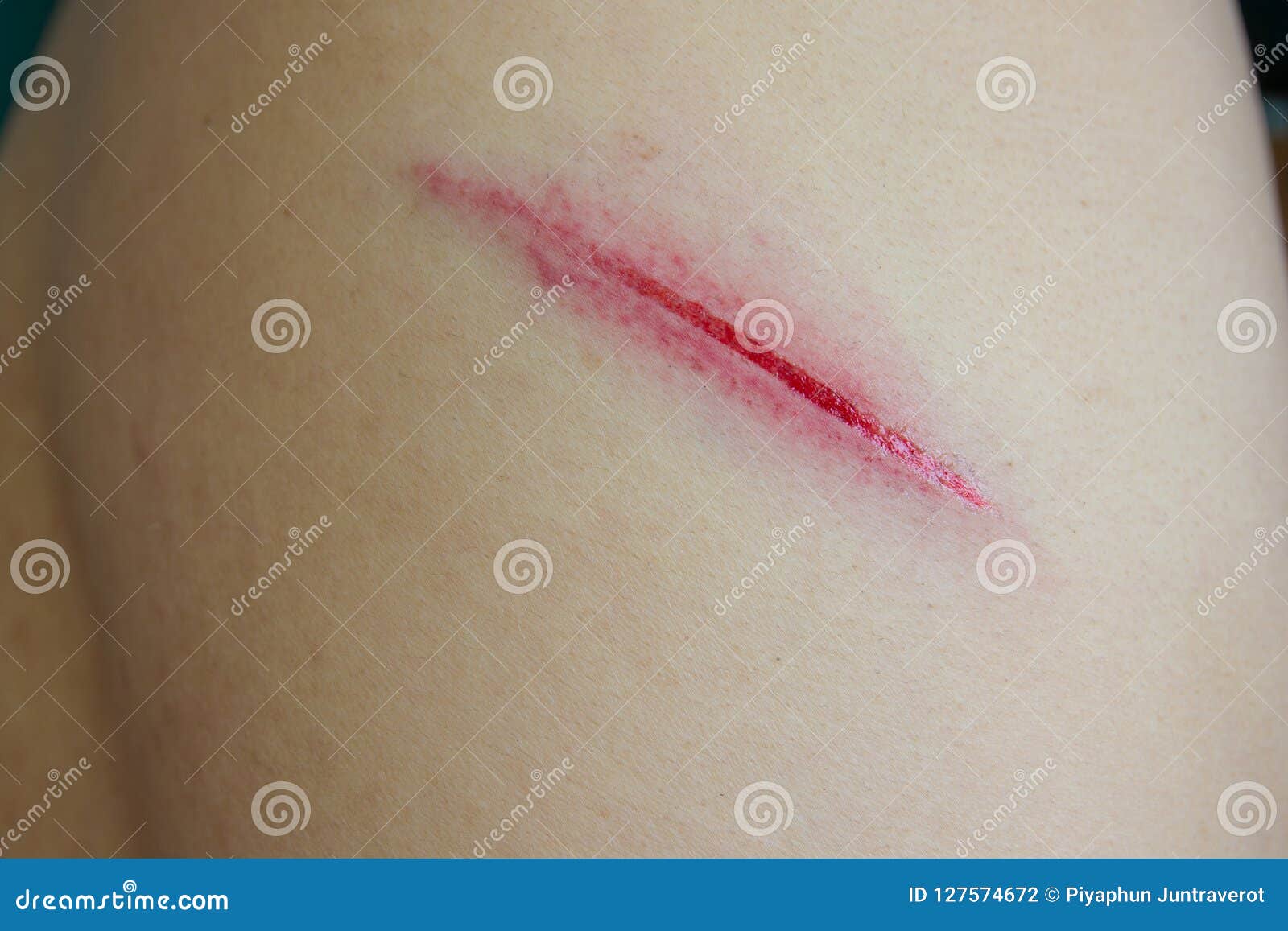 Wound on Back, Fresh Wounds Stock Photo - Image of scratch, human ...