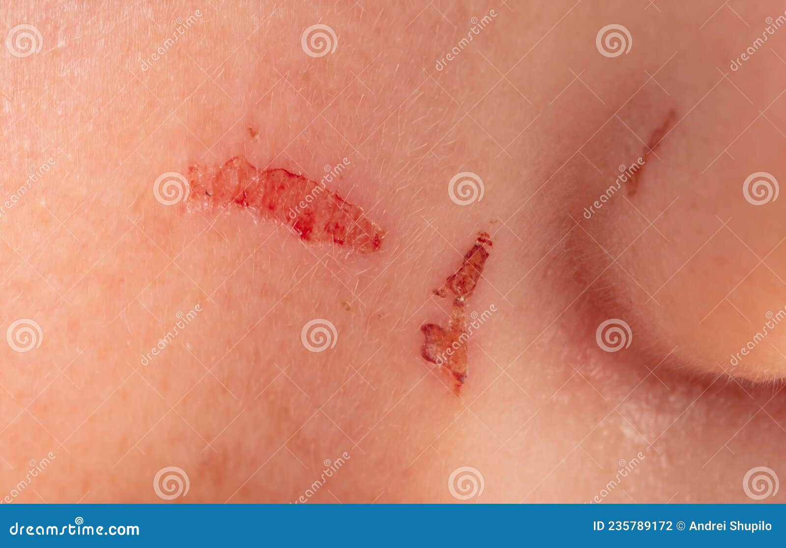 Close-up Wound on Human Skin. Stock Photo - Image of abrasion, injured ...
