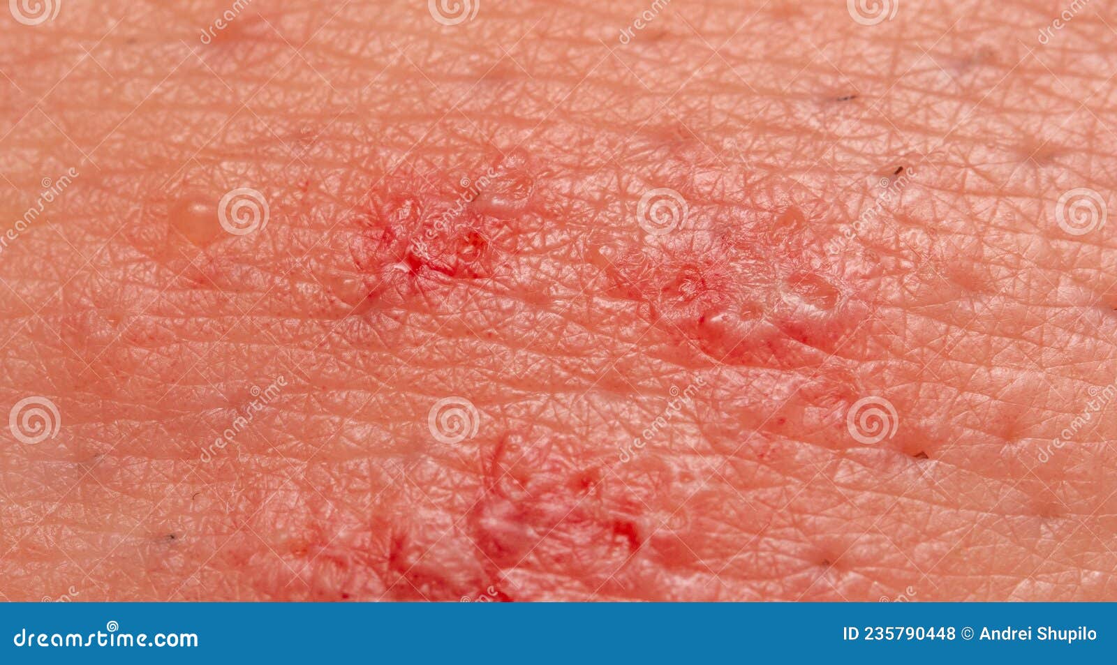 Close-up of a Wound with Pus on Human Skin. Stock Photo - Image of ...