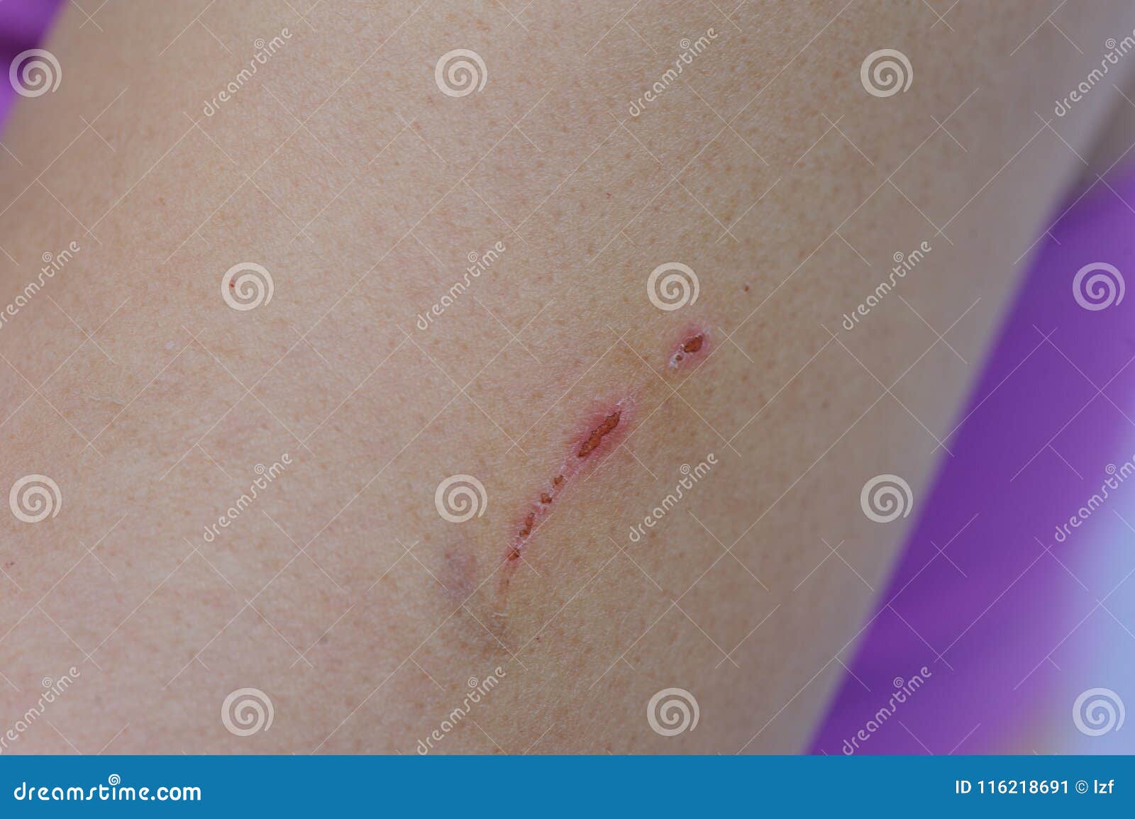 People with wounded arm stock image. Image of bump, livid - 116218691