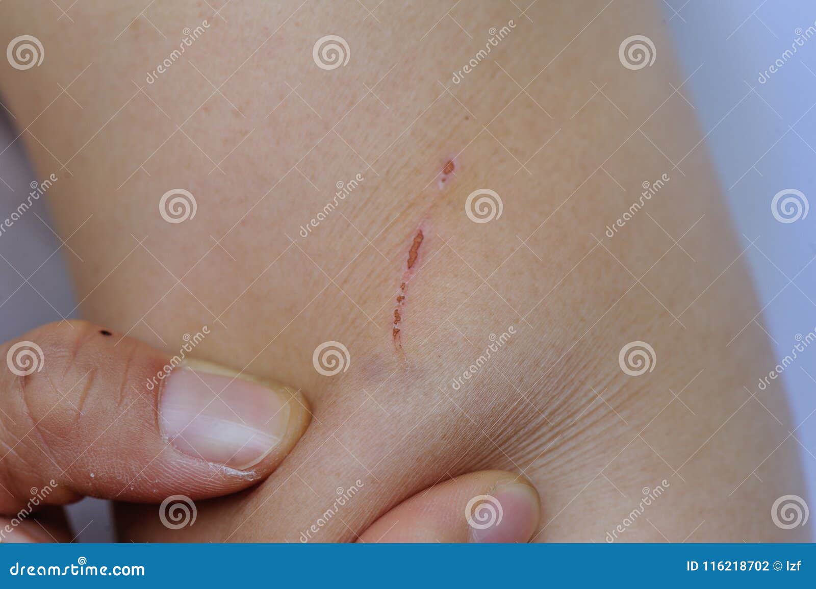 People with wounded arm stock photo. Image of livid - 116218702