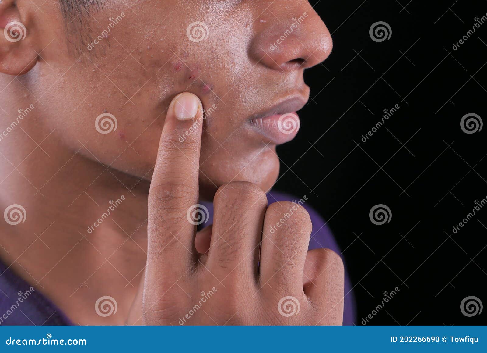 Close Up of Young Man Face with Skin Problem . Stock Photo - Image of ...