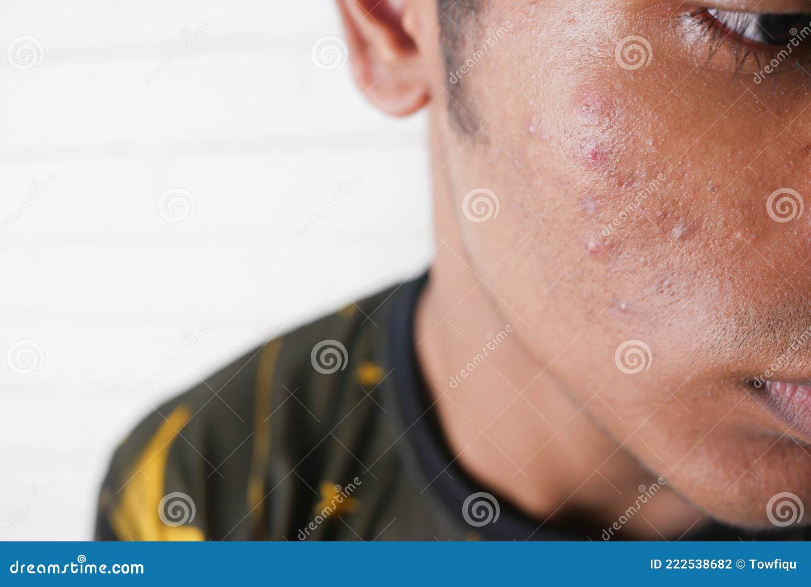 Close Up of Young Man Face with Skin Problem . Stock Photo - Image of ...