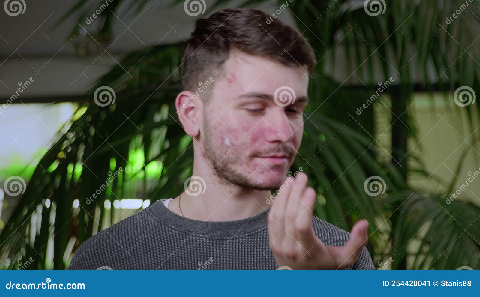 Close-up of a Young Man with Pimples on His Face. the Guy Puts Cream on ...