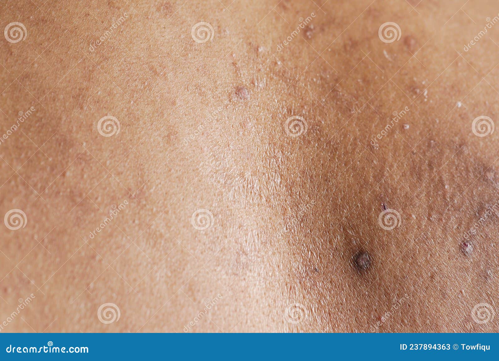 Close Up of Young Man Suffering Skin Problem . Stock Image - Image of ...