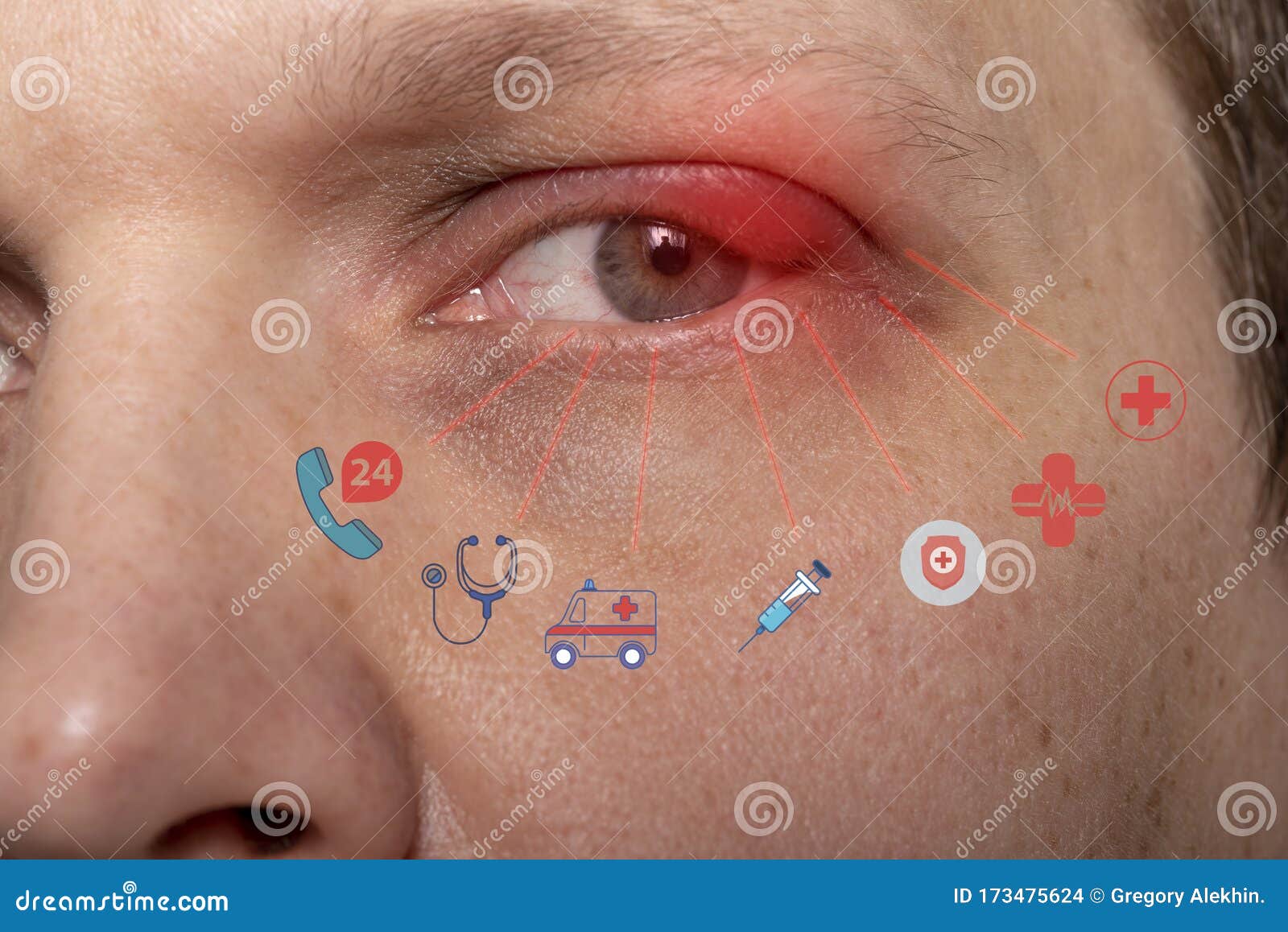 Close the Upper Left Eyelid Abscess. Eye with Barley Stock Photo ...