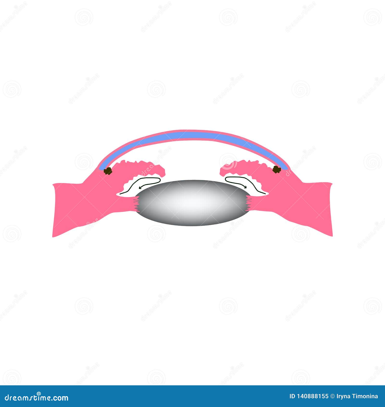 Closed Angle Glaucoma. A Common Type Of Glaucoma. The Anatomical ... Closed Angle Glaucoma. A Common Type Of Glaucoma. The Anatomical ...