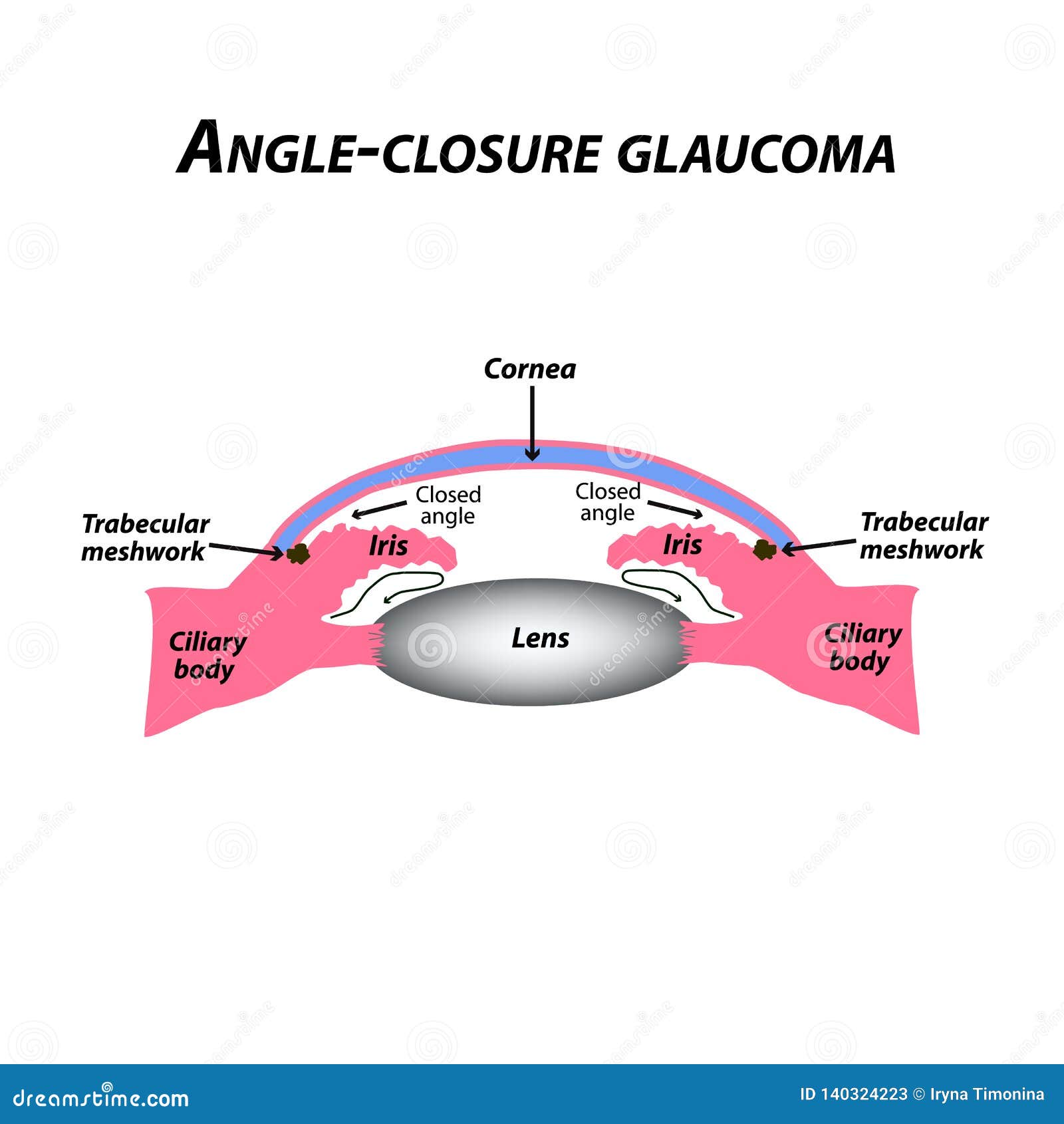 Closed Angle Glaucoma. a Common Type of Glaucoma. the Anatomical ... Closed Angle Glaucoma. a Common Type of Glaucoma. the Anatomical ...